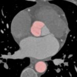 Segmentation of the thoracic aorta in contrast enhanced CT images