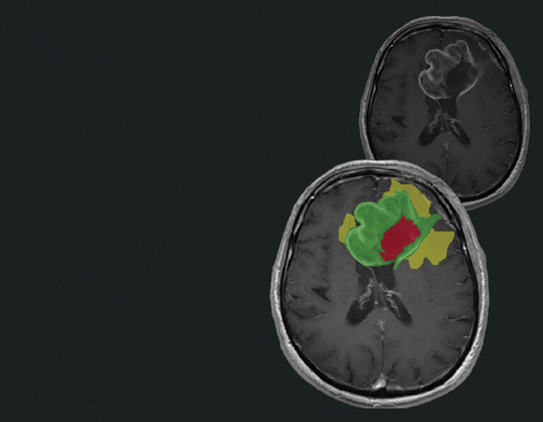 Automated RANO solution for clinical trial