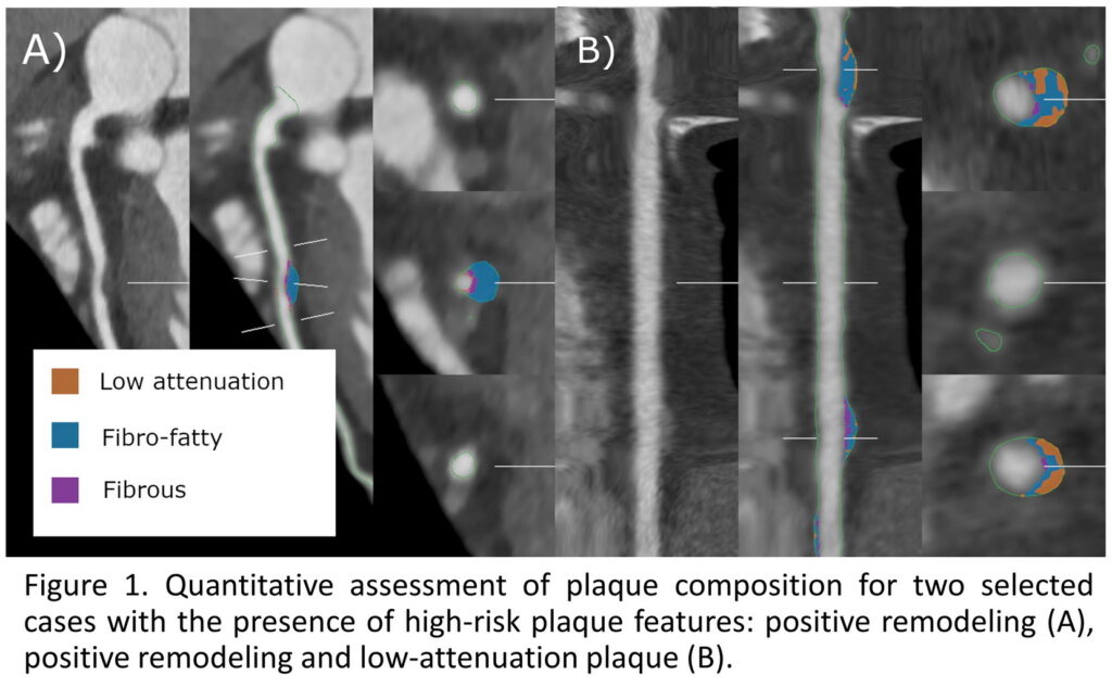 Cardiovascular image analysis: AI and more - Graylight Imaging